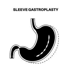 Endoscopic sleeve gastroplasty Royalty Free Vector Image