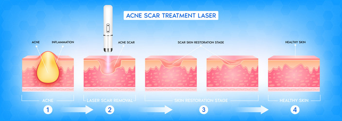Acne scar vascular laser treatment Royalty Free Vector Image