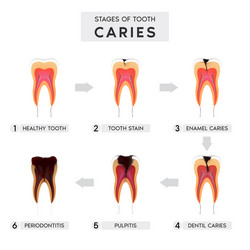 Tooth caries structure2 Royalty Free Vector Image