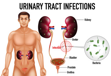 Informative urinary tract infections Royalty Free Vector