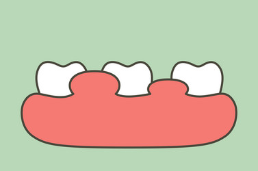 Gingivitis or gum disease with abscess Royalty Free Vector