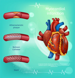 Myocardial infarction 3d realistic stent in heart Vector Image