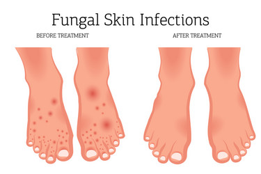 Candidiasis Vector Images (over 130)