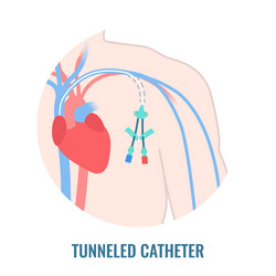 Catheter Vector Images (over 610)
