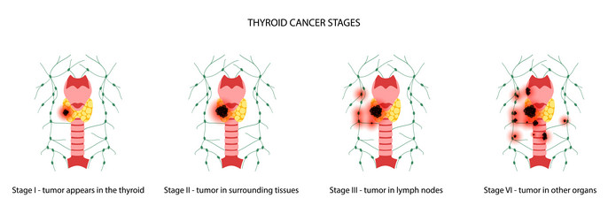 Thyroid cancer stages Royalty Free Vector Image