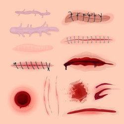Realistic surgical stitches scars bruise Vector Image