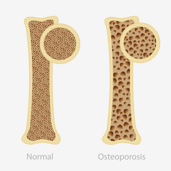 Comparison of normal bone Royalty Free Vector Image
