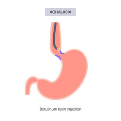 Esophageal botulinum toxin injection Royalty Free Vector