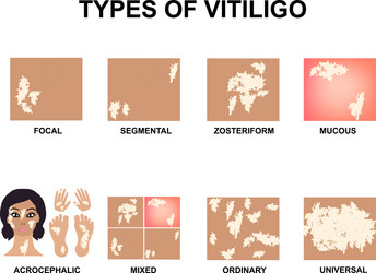 Types vitiligo world vitiligo day Royalty Free Vector Image