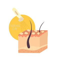 Cartoon hand with psoriasis or eczema Royalty Free Vector