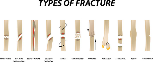 Impacted fracture bone infographics Royalty Free Vector