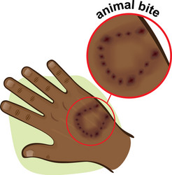 Hand with an animal bite caucasian Royalty Free Vector Image