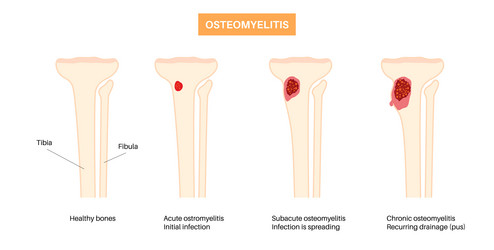 Tibia bone osteomyelitis Royalty Free Vector Image