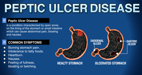 Peptic ulcer disease explained infographic Vector Image