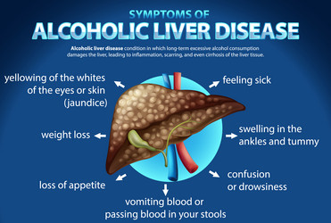 Informative poster of alcoholic liver disease Vector Image