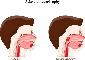 Nasal and throat nasopharynx diseases adenoids Vector Image
