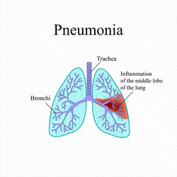 Pneumonia the anatomical structure of human Vector Image