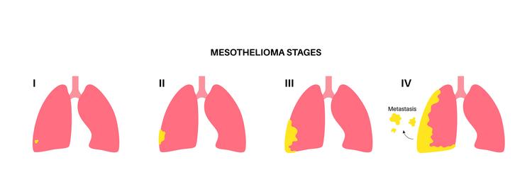Cancer Metastasis Vector Images (over 400)