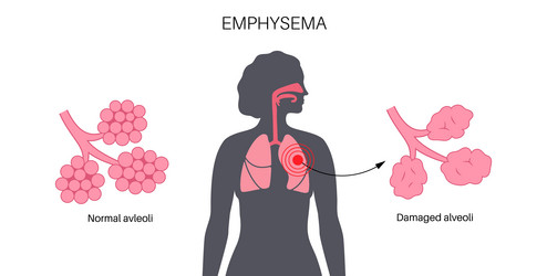Emphysema anatomical poster Royalty Free Vector Image