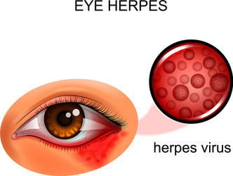 Herpes Virus Vector Images (over 1,300)