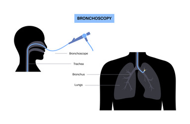 Bronchoscopy procedure concept Royalty Free Vector Image