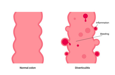 Diverticulitis and diverticulosis Royalty Free Vector Image