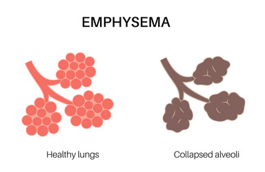 Emphysema anatomical poster Royalty Free Vector Image