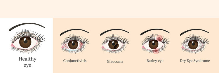 Most common eye problems Royalty Free Vector Image
