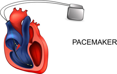 Heart and pacemaker cardiology Royalty Free Vector Image