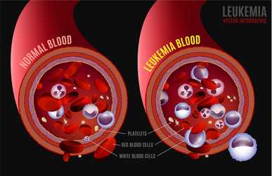 Leukemia medical infographic Royalty Free Vector Image