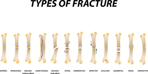 Impacted fracture bone infographics Royalty Free Vector