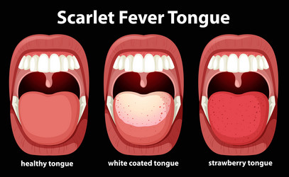Pharyngitis Vector Images (over 370)