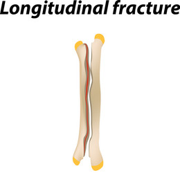 Transverse bone fracture infographics Royalty Free Vector