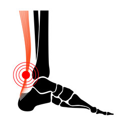 Achilles tendon injury Royalty Free Vector Image