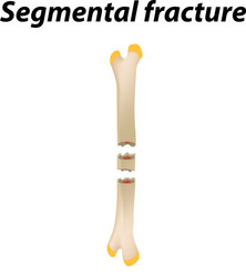 Open Fracture Vector Images (over 510)