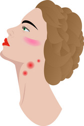Swollen lymph nodes in womans neck Royalty Free Vector Image