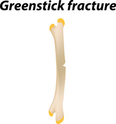 Open Fracture Vector Images (over 510)