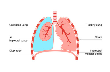 Chest Tube Vector Images (over 620)