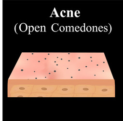 Open comedones acne on skin dermatological Vector Image
