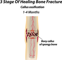 Stages of healing bone fracture formation Vector Image