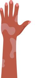 Human vitiligo hand Royalty Free Vector Image - VectorStock