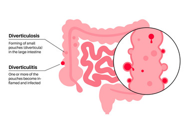 Diverticulitis and diverticulosis Royalty Free Vector Image