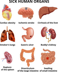 Realistic sick human organs set anatomy Royalty Free Vector