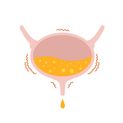 Overactive bladder urinal overflow Royalty Free Vector Image