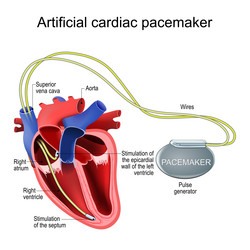 Pacemaker Vector Images (over 860)