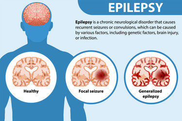 Informative poster of epilepsy Royalty Free Vector Image