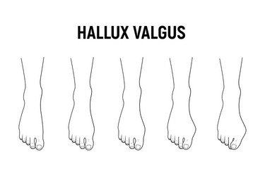 Hallux valgus mild bunion Royalty Free Vector Image
