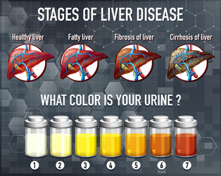 Stages liver disease Royalty Free Vector Image