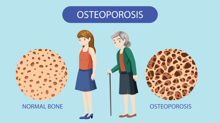 Bone density and osteoporosis Royalty Free Vector Image