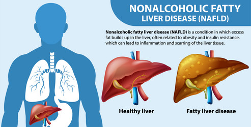 Nafld Vector Images (33)